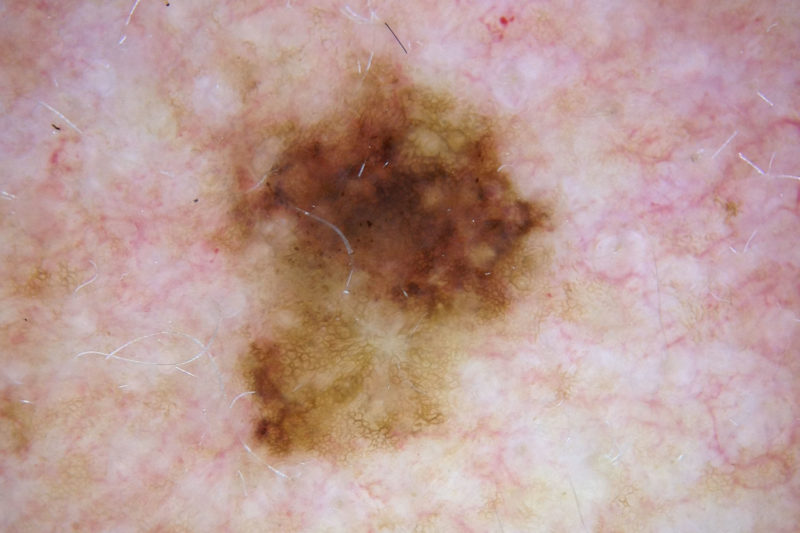 Gallery - Brisbane Skin Cancer